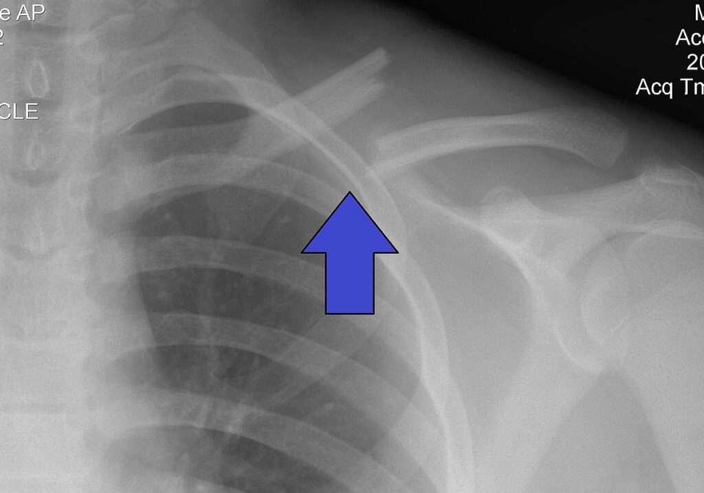 Broken collar bone – Dr. Edward Weldon