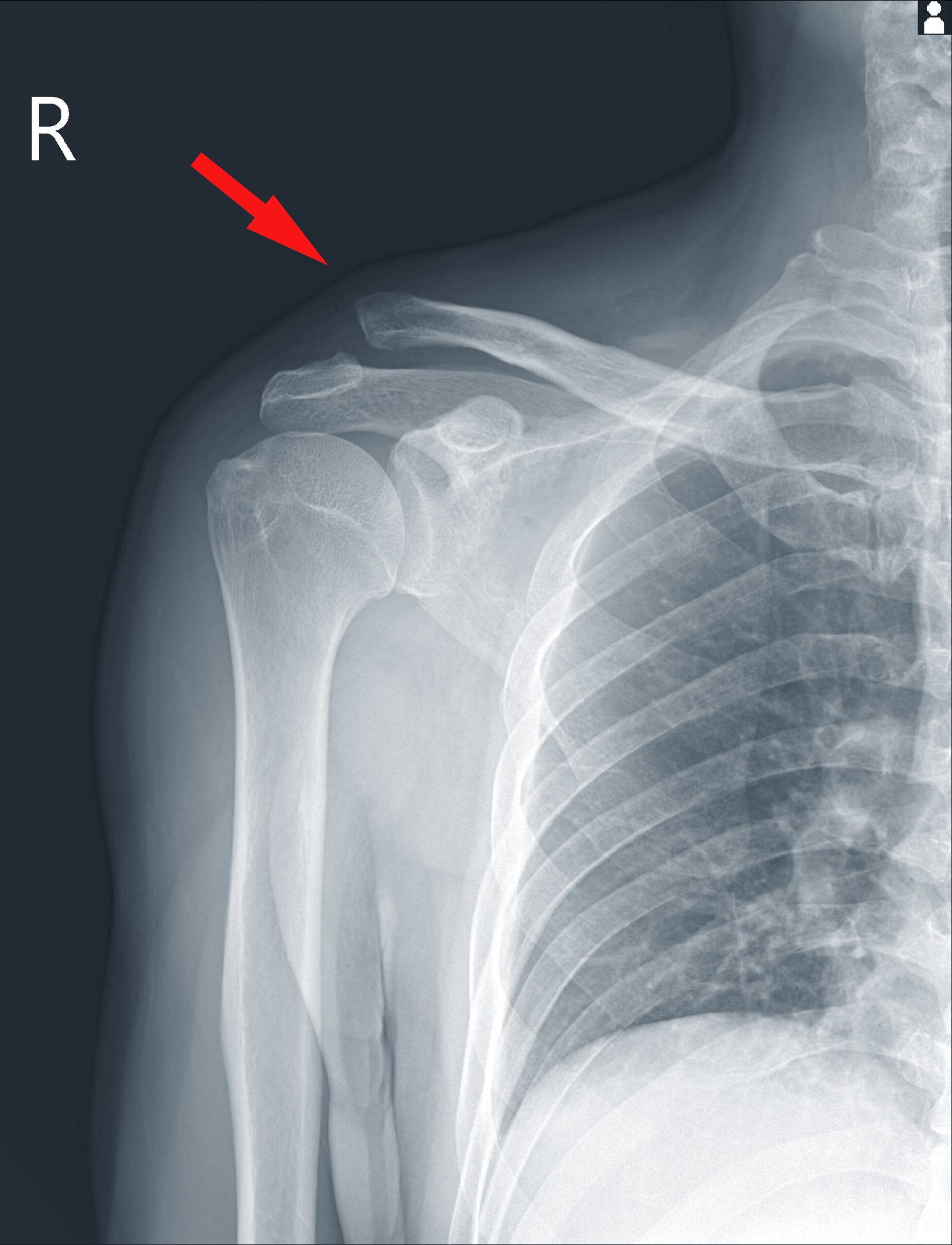 Acromioclavicular (AC) Separation – Dr. Edward Weldon