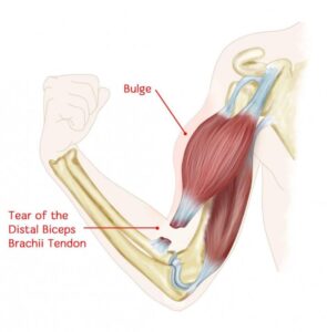 Distal Biceps Tendon Tear – Dr. Edward Weldon