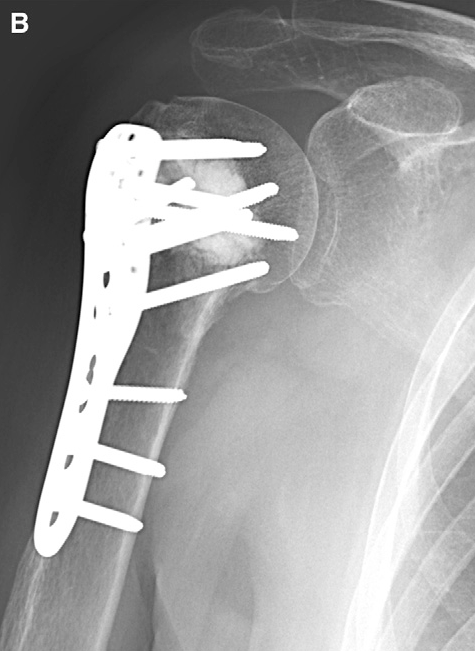 Broken bones of the shoulder – Dr. Edward Weldon