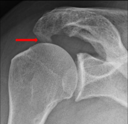 Bone Spurs – Dr. Edward Weldon