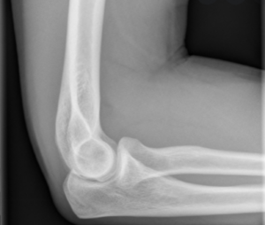 Elbow Arthritis – Dr. Edward Weldon