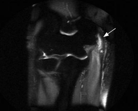 Golfer’s Elbow – Dr. Edward Weldon