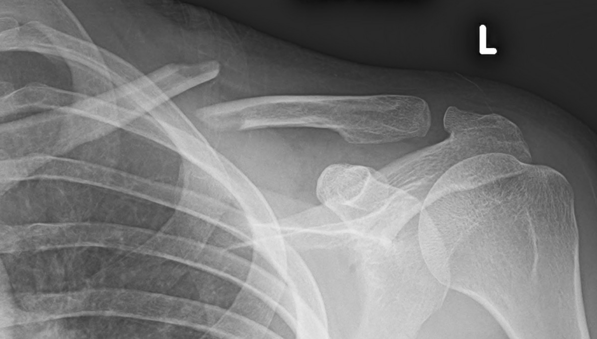 Repairing Broken Bones of the Collar Bone/Clavicle – Dr. Edward Weldon