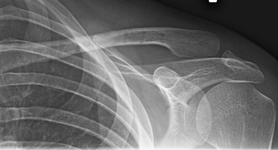 Repairing Broken Bones of the Collar Bone/Clavicle – Dr. Edward Weldon