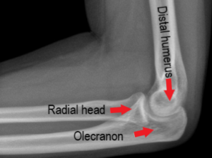 Repairing Broken Bones of the Elbow – Dr. Edward Weldon