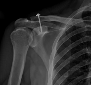 AC (acromioclavicular) Joint Repair and Reconstruction – Dr. Edward Weldon