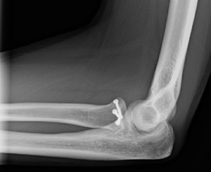 Repairing Broken Bones of the Elbow – Dr. Edward Weldon