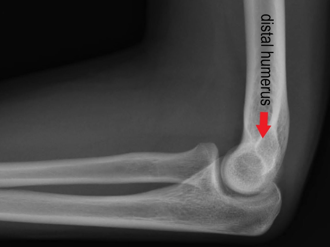 Broken Bones of the Elbow – Dr. Edward Weldon