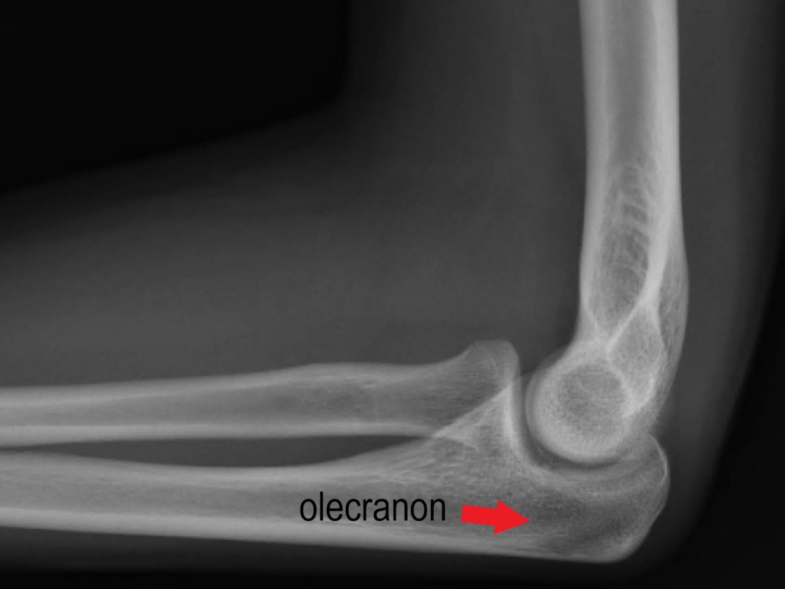 Broken Bones of the Elbow – Dr. Edward Weldon