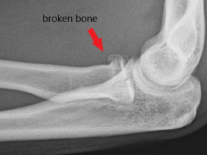 Broken Bones of the Elbow – Dr. Edward Weldon