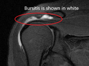 Shoulder Bursitis – Dr. Edward Weldon