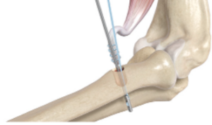 Distal Biceps Tendon Repair (Repair the Biceps Tendon from the Elbow ...