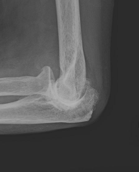 Elbow Replacement/Arthroplasty – Dr. Edward Weldon