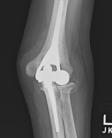 Elbow Replacement/Arthroplasty – Dr. Edward Weldon