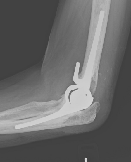 Elbow Replacement/Arthroplasty – Dr. Edward Weldon