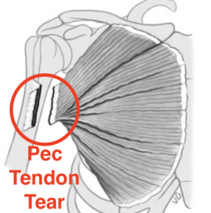 Pectoralis tendon tear – Dr. Edward Weldon